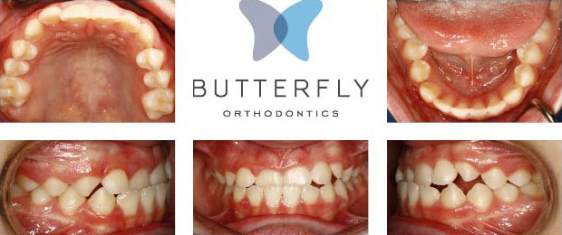 Before and After - Butterfly Orthodontics | Best Phoenix AZ Orthodontist