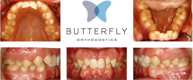 Before and After - Butterfly Orthodontics | Best Phoenix AZ Orthodontist