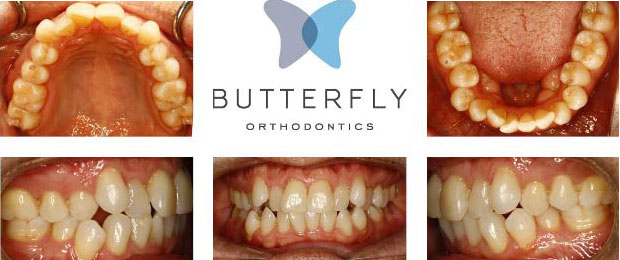 Before and After - Butterfly Orthodontics | Best Phoenix AZ Orthodontist